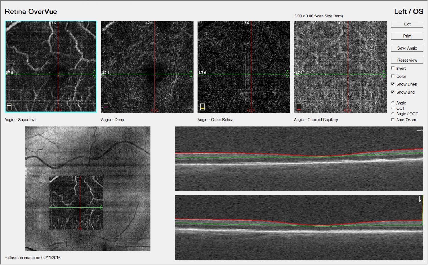 OCT Angiography – Visual Surgery