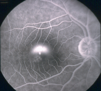 Central Serous Retinopathy – Visual Surgery