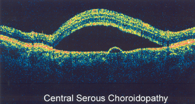 Central Serous Retinopathy – Visual Surgery