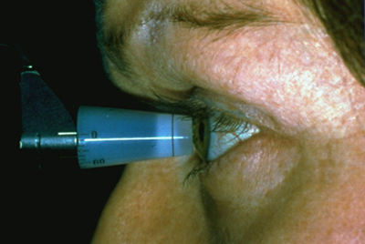 Glaucoma Testing – Visual Surgery