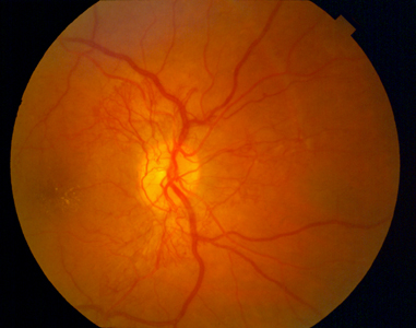 Pan-Retinal Photocoagulation – Visual Surgery