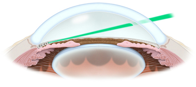 SLT Treatment – Visual Surgery